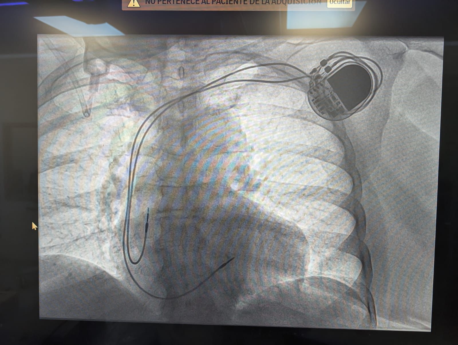 Histórico avance en Salud Pública de Quintana Roo: Primer marcapasos implantado en Cancún ...